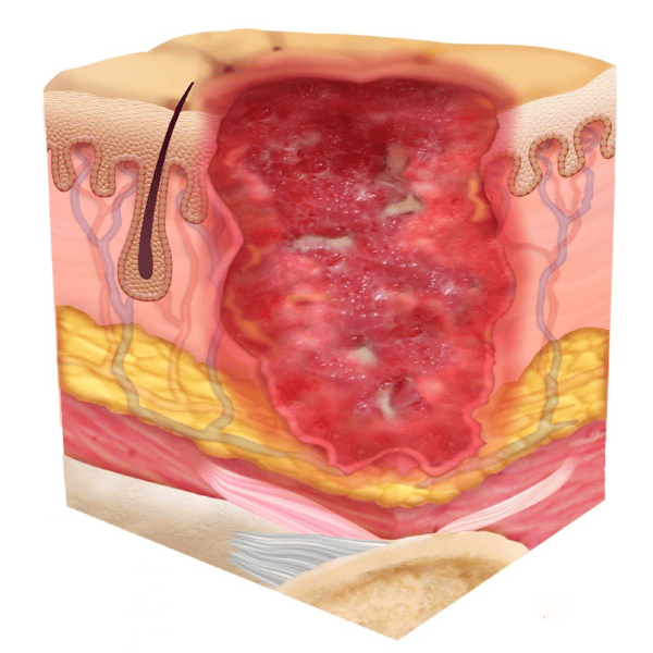 Understanding Pressure Injuries: The 4 Stages