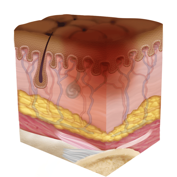 Understanding Pressure Injuries: The 4 Stages