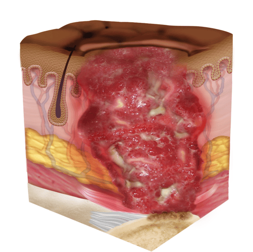 Understanding Pressure Injuries: The 4 Stages