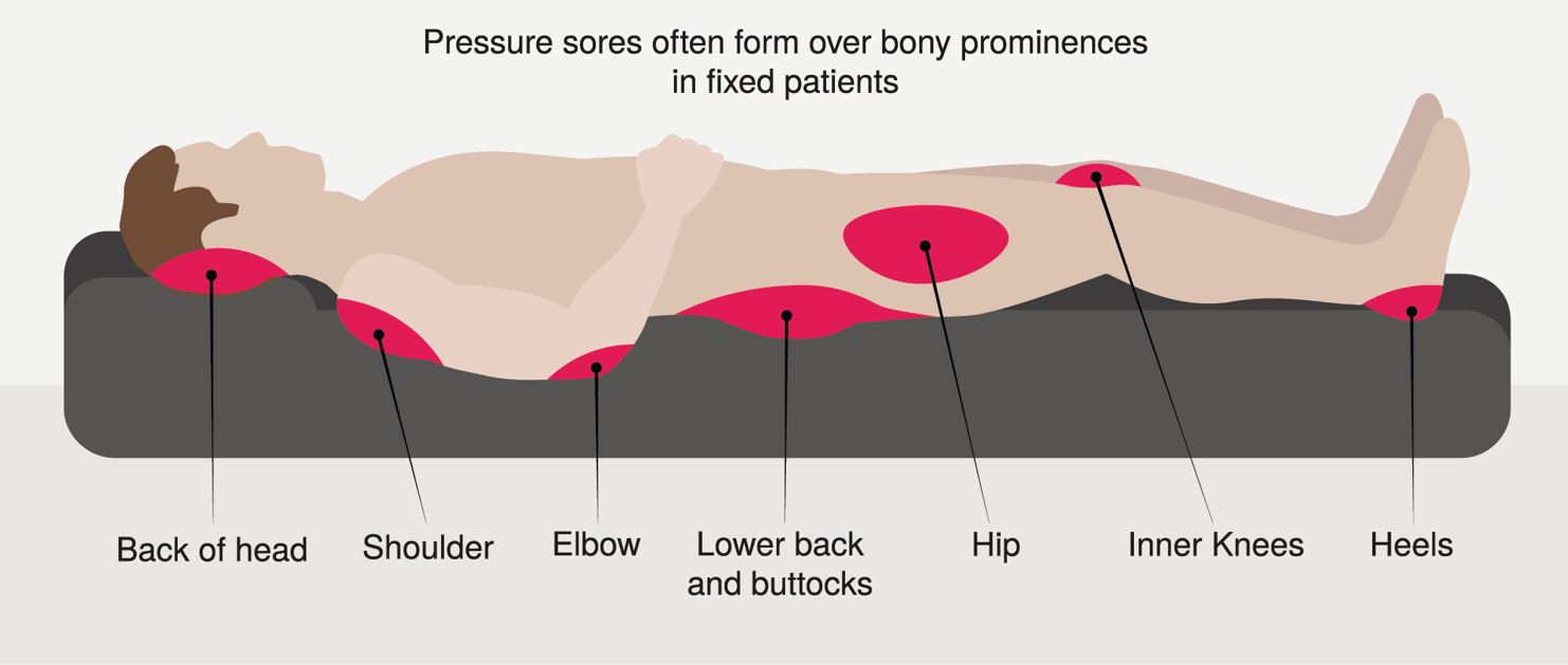 Understanding Pressure Injuries: The 4 Stages