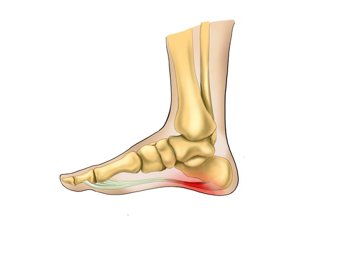 Pressure Points For Plantar Fasciitis Insights Into Relief Options