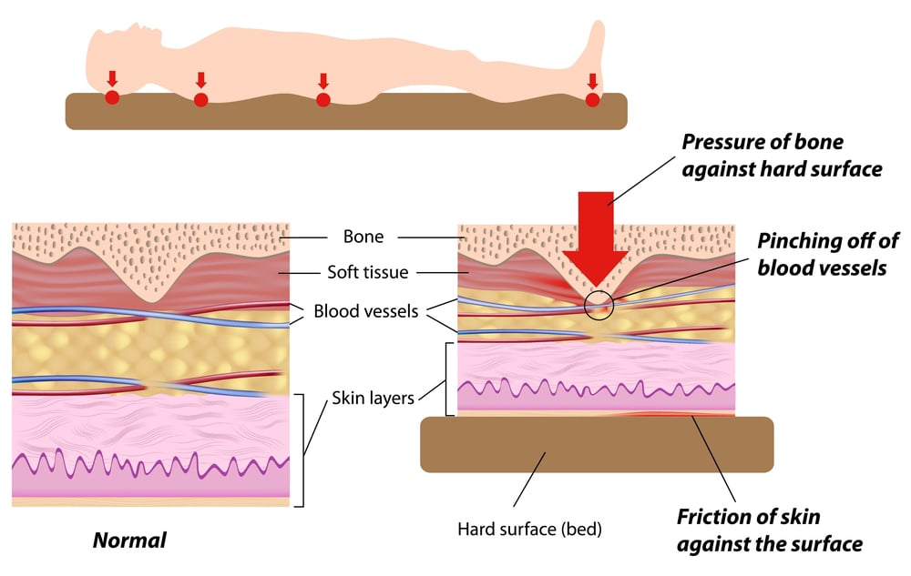 Understanding Pressure Injuries: The 4 Stages